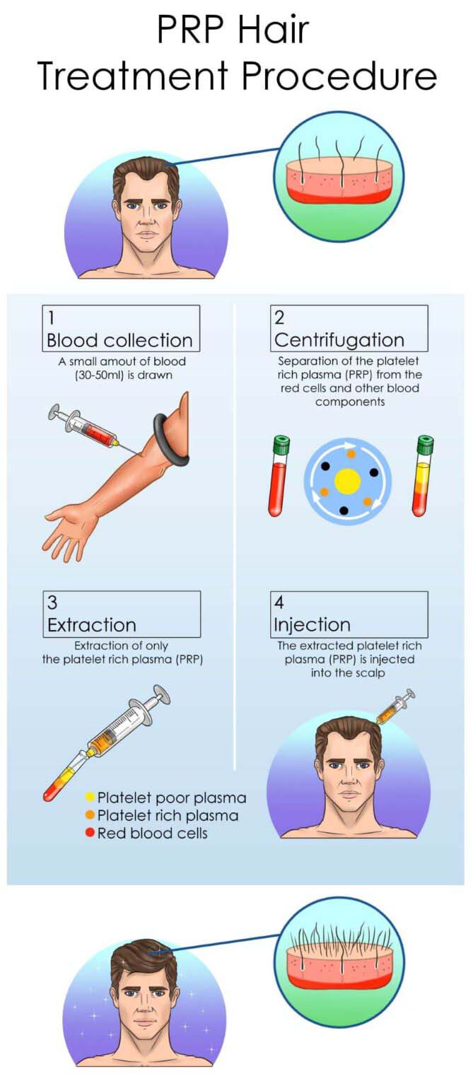 PRP Hair Treatment - Anasin Clinic