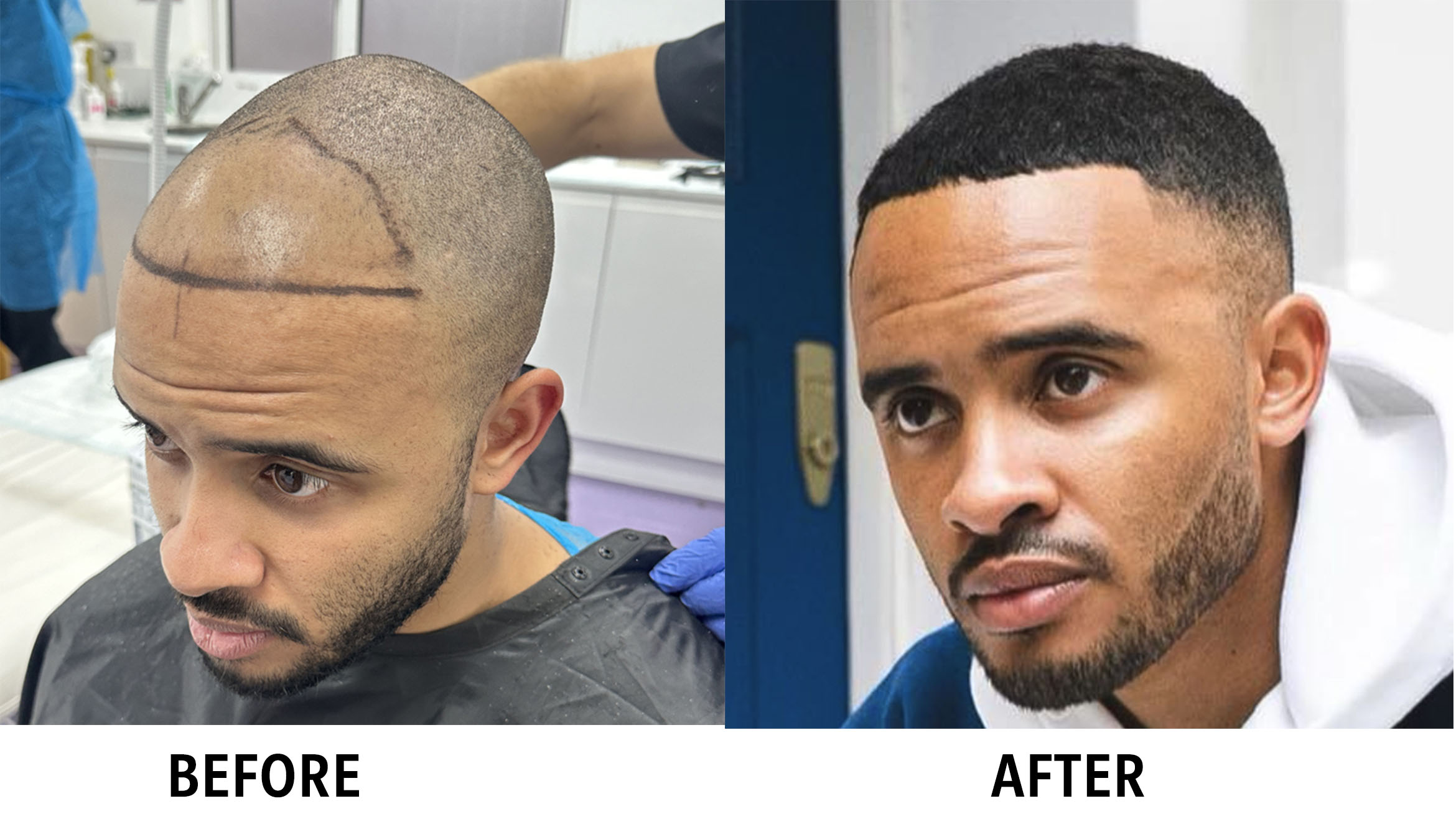 Afro Hair Transplant - Anasin Clinic